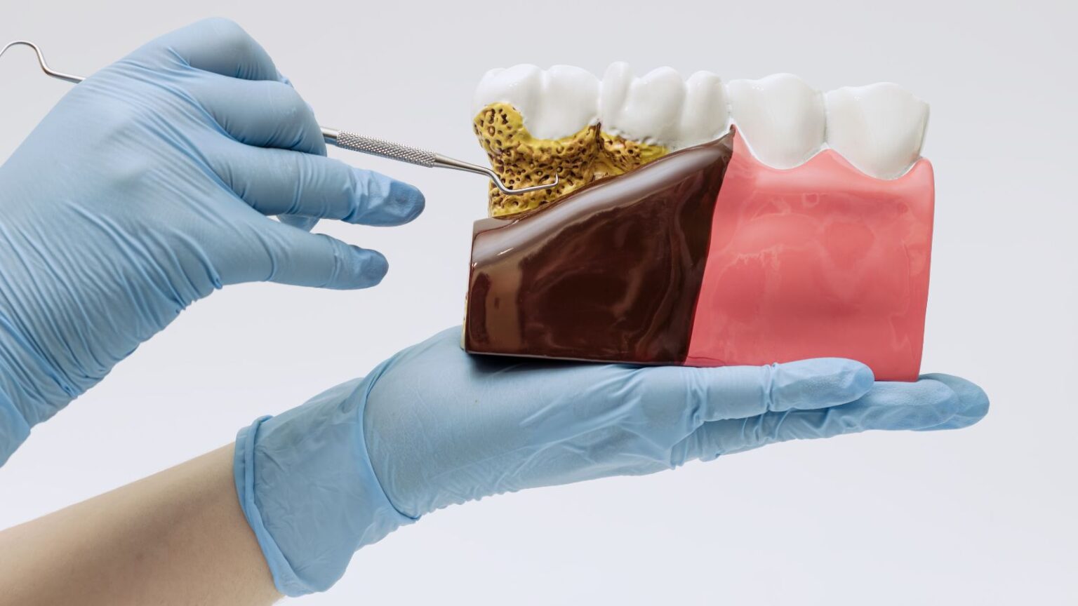 The Difference Between Bone Loss from Gum Disease and Bone Loss from ...